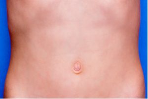 Hérnia umbilical: Como identificar e tratar